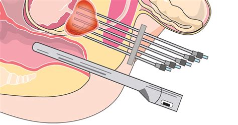 Treating Prostate Cancer With High Dose Rate Brachytherapy Chum