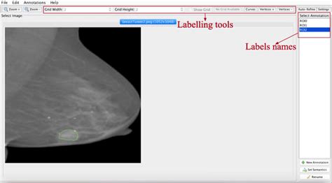 Breast Tumor Annotation Using Ratsnake Tool Download Scientific Diagram
