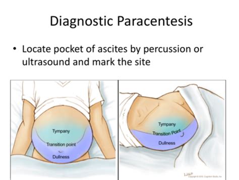 Paracentesis Position Paracentesis Procedure