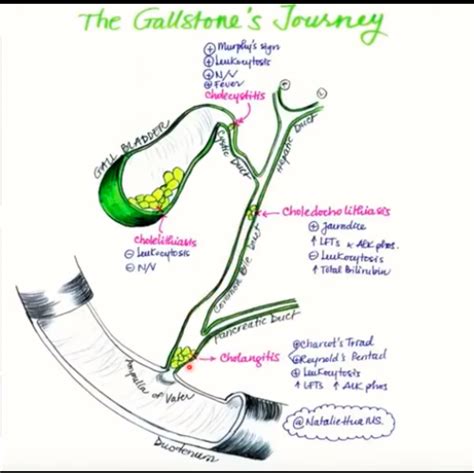 Ctp Biliary Disorders Flashcards Quizlet