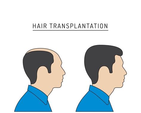 Prezzo Di Un Trapianto Di Capelli FUE In Tunisia MiglioreClinica