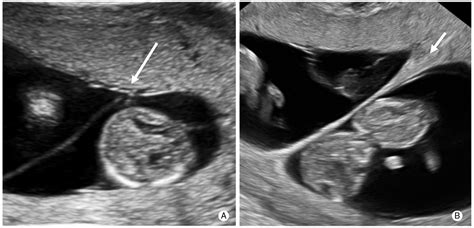 Monochorionic Diamniotic Twins Identical
