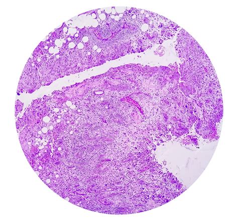 Premium Photo Photomicrograph Of Breast Abscess Granulomatous