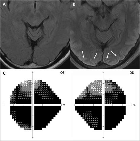 Delayed Cortical Blindness In Hypoxic Ischemic Encephalopathy Pmc
