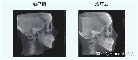 Hibeauty隐秀「牙列拥挤 单侧后牙锁牙合 骨性偏牙合代偿性矫治 」案例分享 知乎