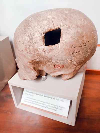 Trepanaciones Craneanas De La Cultura Paracas Medicina Audaz