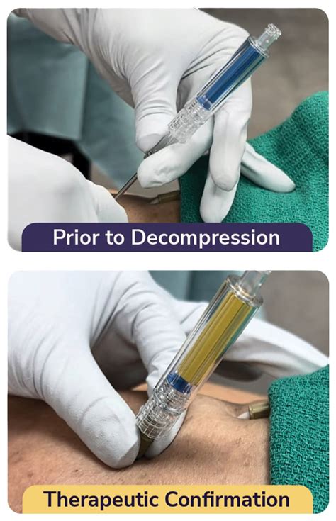 Objectively Confirm Needle Thoracostomy Placement And Success With