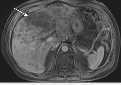 Ct Abdomen Case 3 Showing Large Central Hepatic Mass 8 4x8 4x3 2 Cm