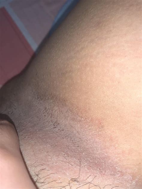 Why Is My Groin Area Chalky It Looks Like Its Peeling 2 Days Ago It
