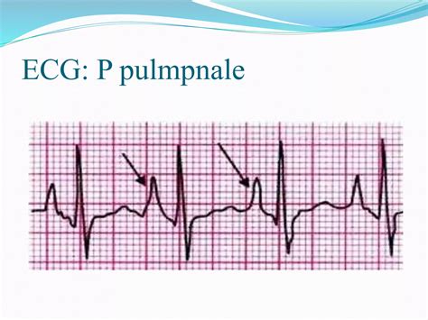 Tricuspid Valve Disease Pptx Heart And Cardiovascular Diseases