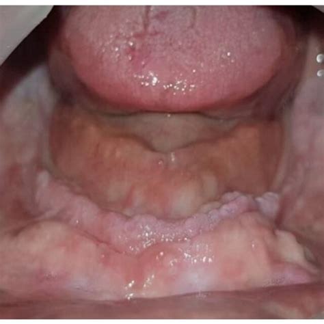 Hyperplastic Tissue Folds In The Mandibular Buccal Download