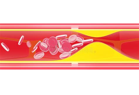 Anatomical 3d Illustration Of The Interior Of An Artery Showing The