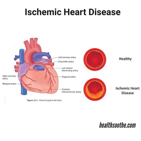 Coronary Artery Flow Chart Pathophysiology Of Ischemi Vrogue Co