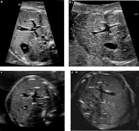 Figure 2 From In Utero Evaluation Of The Fetal Umbilical Portal Venous