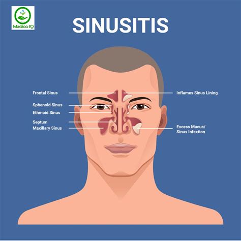 Extreme Fatigue Sinus Infection At Lachlan Ricardo Blog