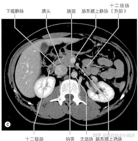 胰腺影像解剖 知乎