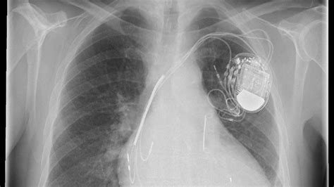 Pacemaker And Implantable Defibrillator Dr Paul Ong