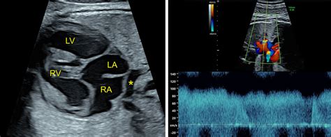 Total Anomalous Pulmonary Venous Connection In A Fetus With Heterotaxy