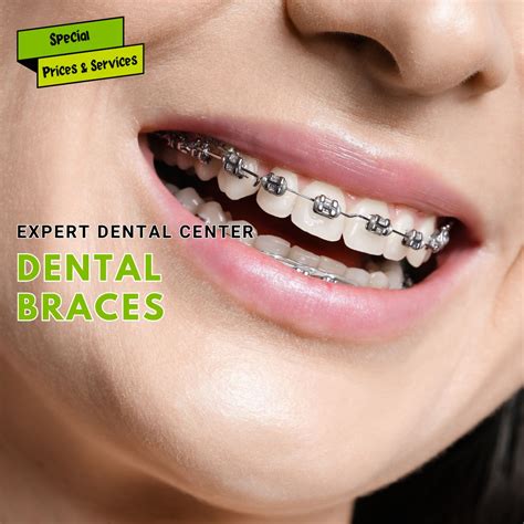 Dental Braces