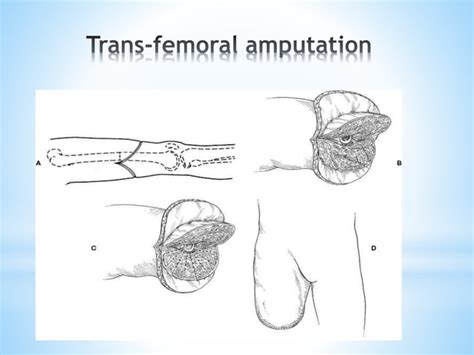 Amputations Of Extremity Pptx Injuries Diseases And Conditions