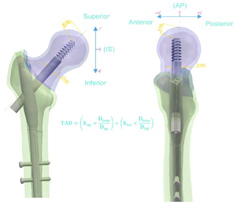 Simulation Of AO A Fracture And Description Of Tip Apex Distance Download Scientific Diagram