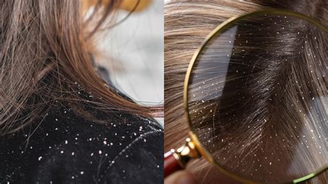 Dandruff Vs Dry Scalp Remy And Virgin