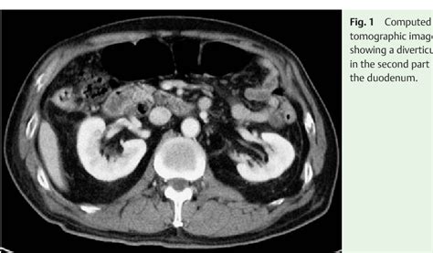 Pdf Acute Obstructive Cholangitis Caused By An Enterolith In A