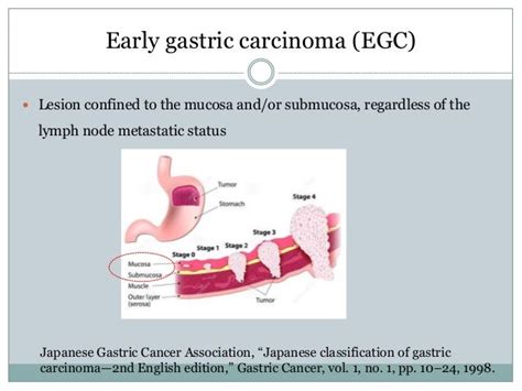 Early Gastric Cancer