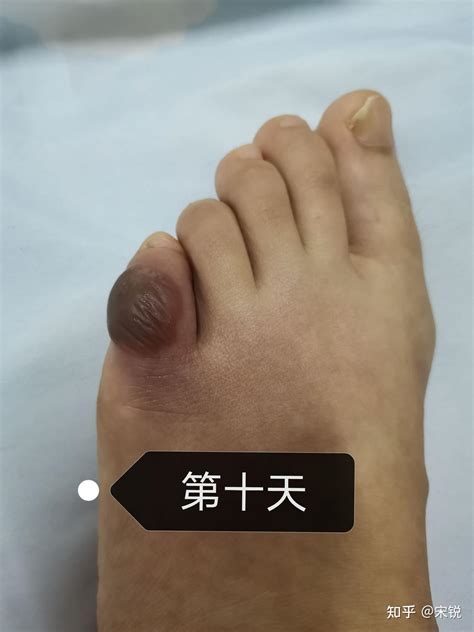 脚趾外侧长了一个鸡眼，记录液氮冷冻治疗过程 知乎