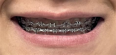 Reverse Curve Wire R Braces