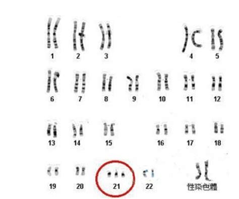 为啥“唐氏儿”小时候长得不一样，长大后都差不多？视觉上的错觉 搜狐大视野 搜狐新闻