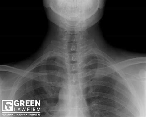 Want To Know The Average Settlement For A Whiplash Injury