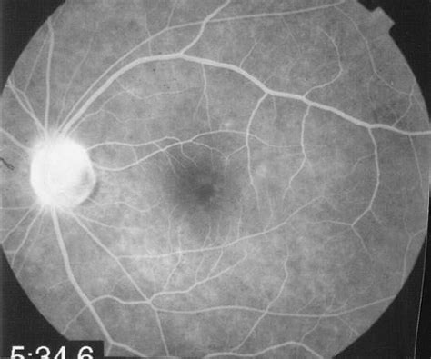Inflammatory Choroiditis Ento Key