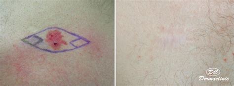 Cáncer De Piel Dermaclinic