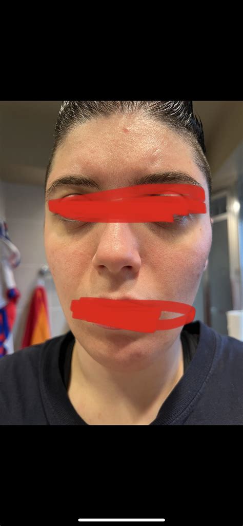 Opinion Malar Rash I Also Have Other Telltale” Symptoms Of Something