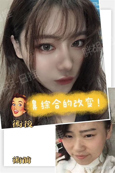 耳软骨鼻综合术后整体形象上升气质优美改变人生的高性价比项目 知乎