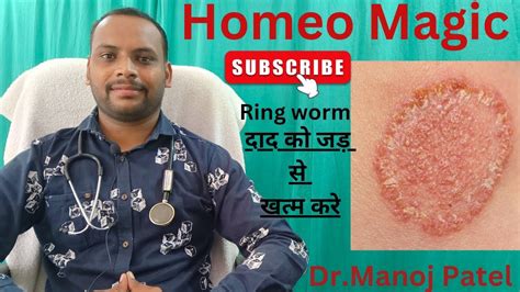 Ring Worm Fungle Infection दाद Youtube