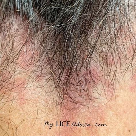 Can Head Lice Live On Your Skin At Randy Cone Blog