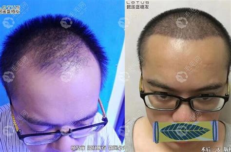 喂看了苏州碧莲盛的头顶大面积植发案例后你觉得怎么样 热点资讯 毛毛网