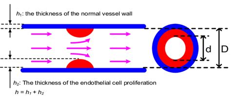 The Definition Of Degree Of Stenosis Dos Which Is Defined As The Download Scientific Diagram