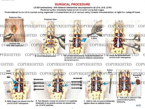 Lumbar Spine Decompression Laminectomy — Medical Art Works