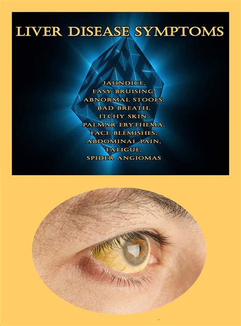 Black Stools Liver Disease At Samantha Sternberg Blog