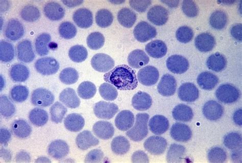 Free Picture Blood Smear Old Immature Schizont Plasmodium Malariae