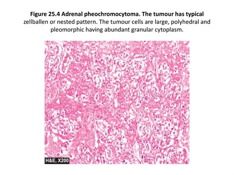 Adrenal Gland Pathology Pptx