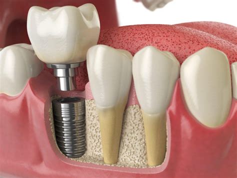 Bar Retained Overdenture Ddi Dorset