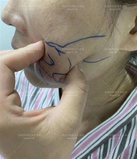 适不适合吸脂得先看自己是哪种类型再行动！ 知乎