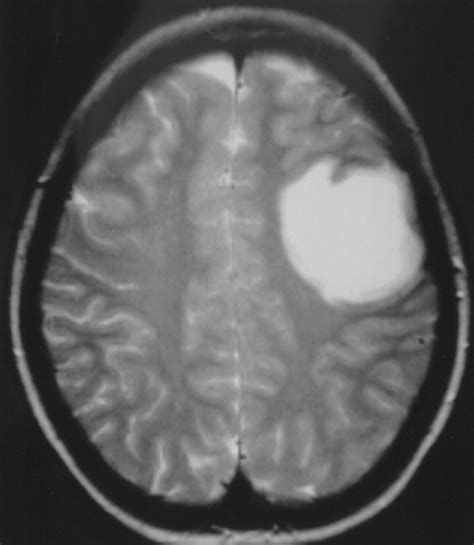 The Mri Appearance Of Tumefactive Demyelinating Lesions Ajr
