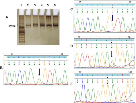 A Sscp Analysis Of The Pcr Products Of The Exon 1 Of Mbl2 Gene In Rhd