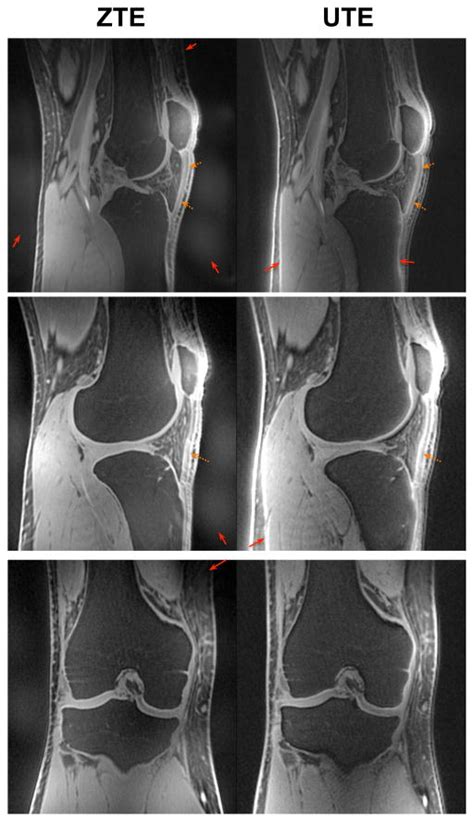 Ultrashort Echo Time And Zero Echo Time Mri At 7t Pmc
