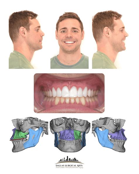 Jaw Repositioning Orthognathic Surgery Dallas Surgical Arts